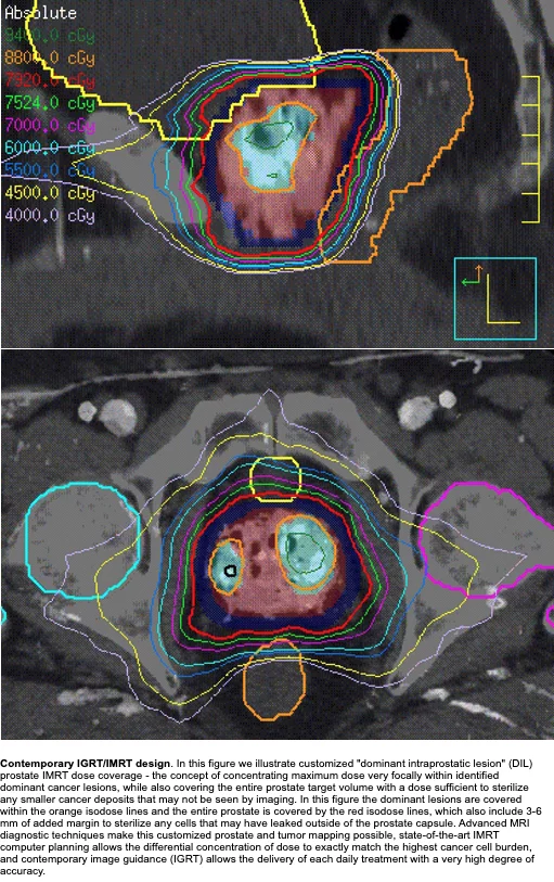 IGRT / IMRT for Prostate Cancer | Unio Specialty Care